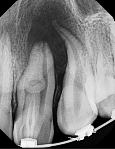 VERY unusual tooth! - Magnolia Endo