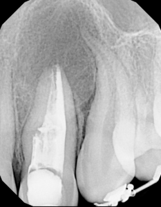 VERY unusual tooth! - Magnolia Endo